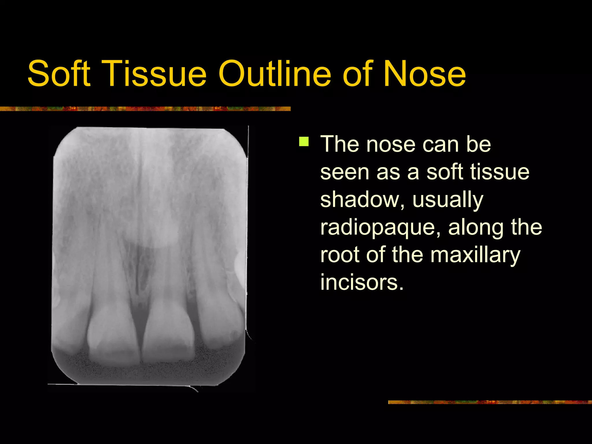Intra Oral radiographic anatomical landmarks | PPT