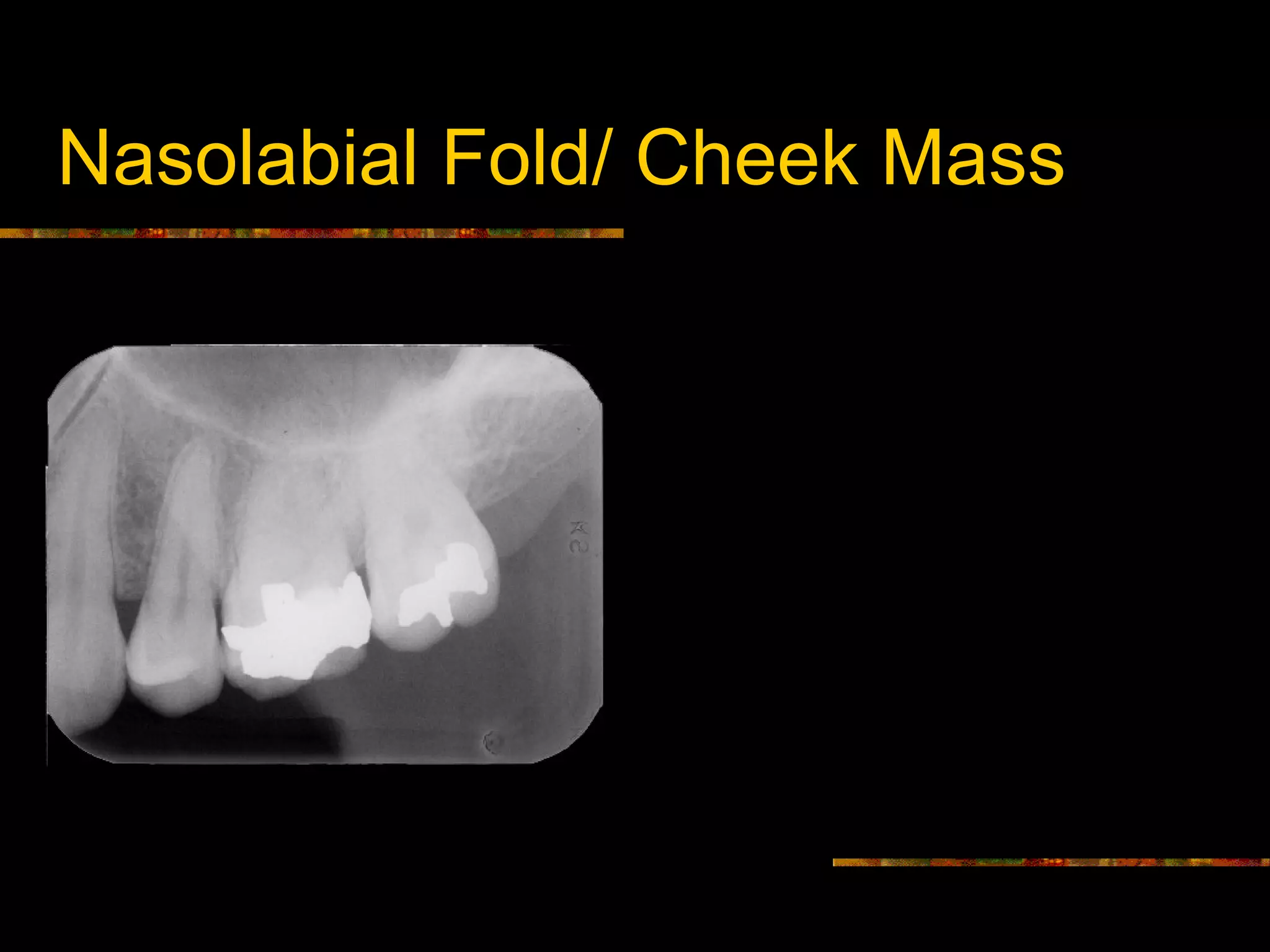 Intra Oral radiographic anatomical landmarks | PPT