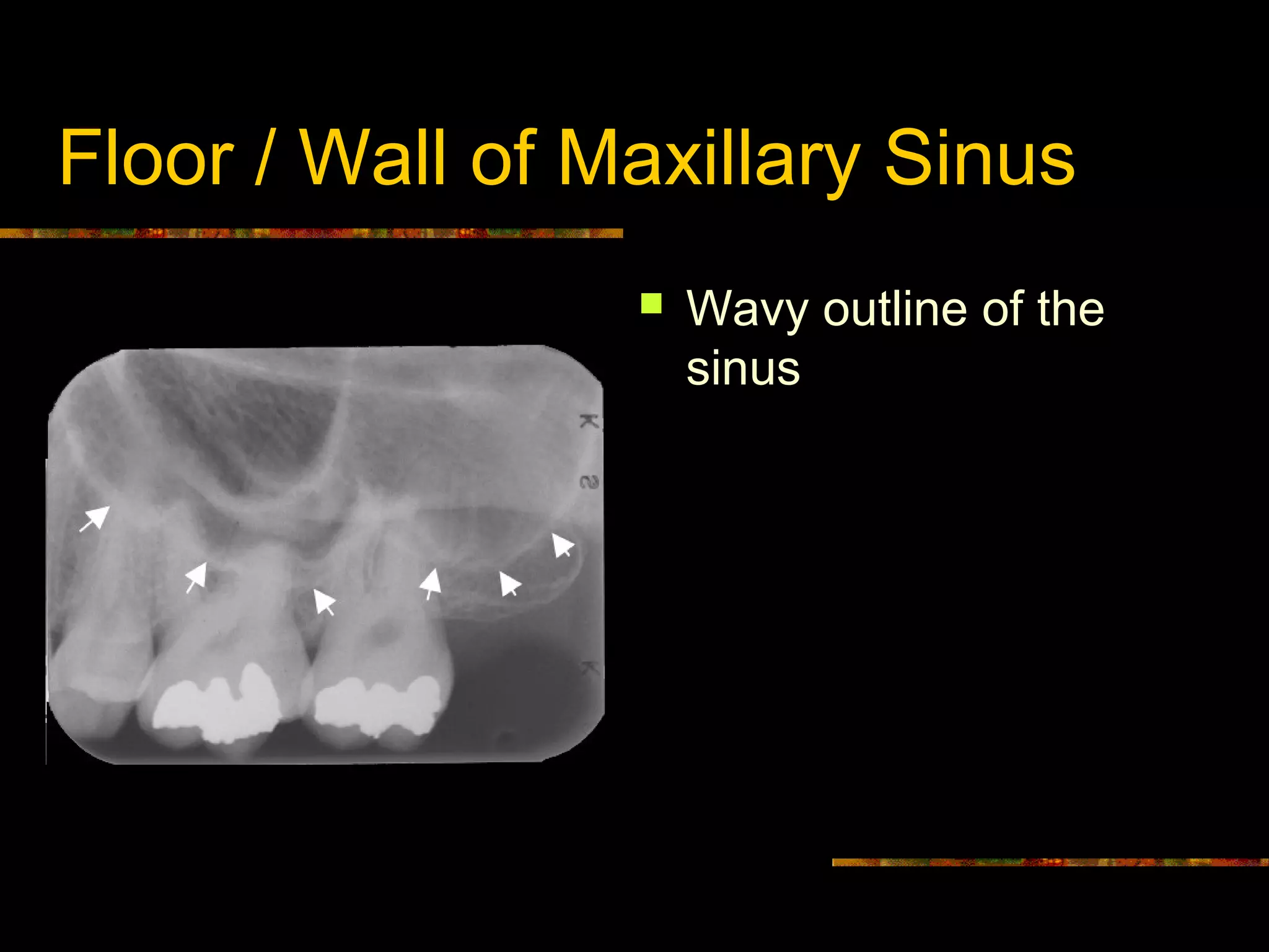 Intra Oral radiographic anatomical landmarks | PPT