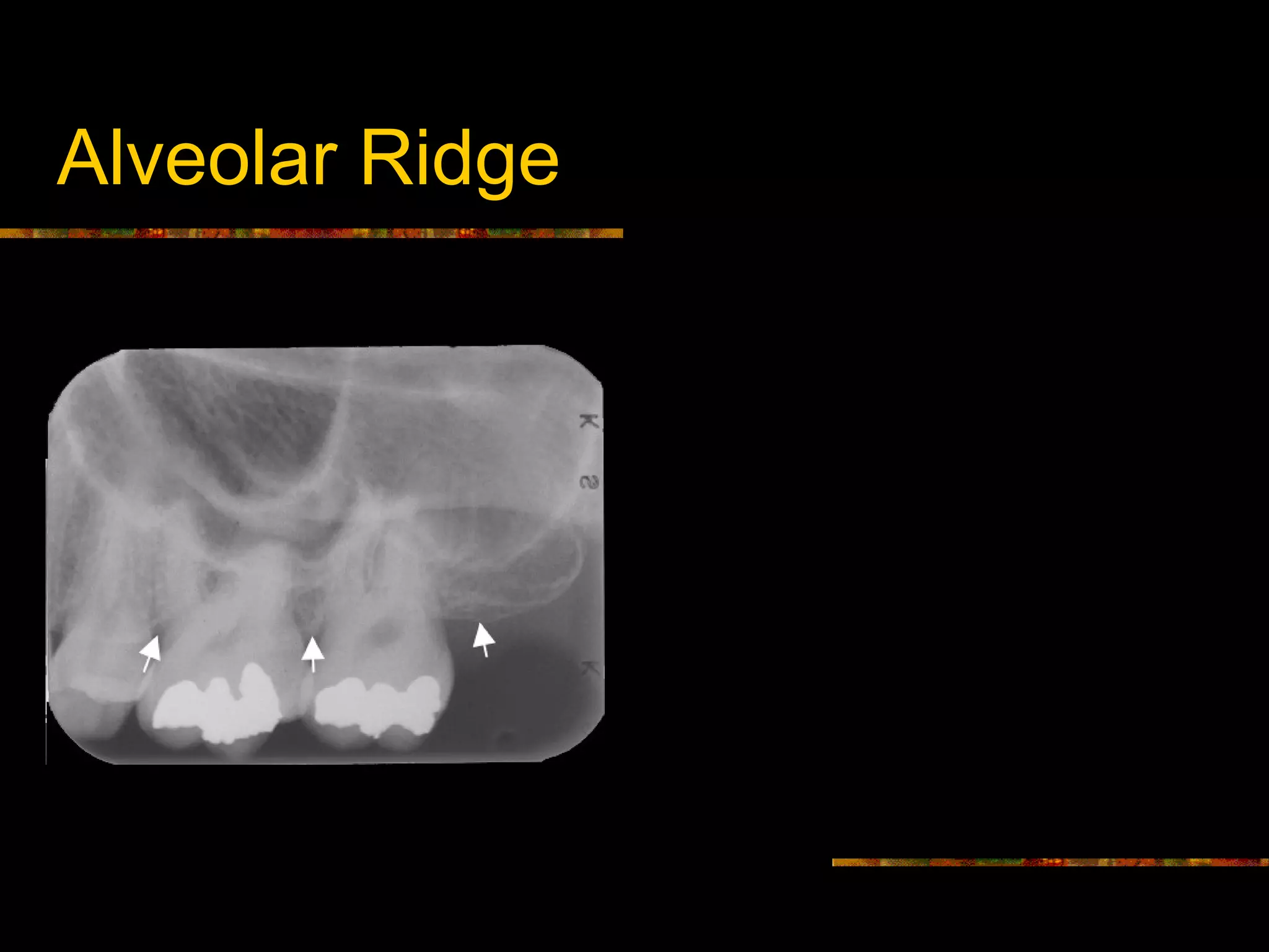Intra Oral radiographic anatomical landmarks | PPT