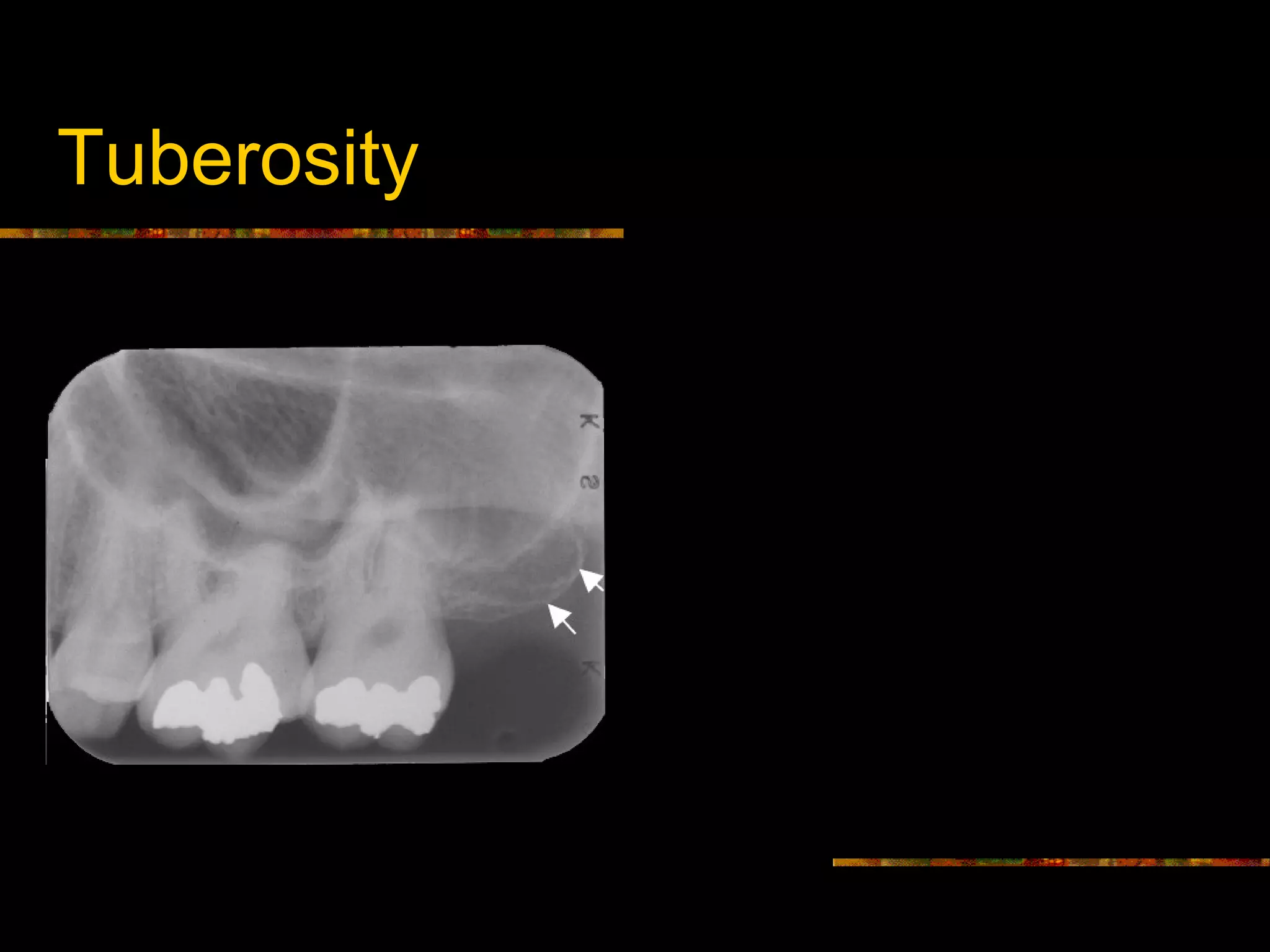 Intra Oral radiographic anatomical landmarks | PPT