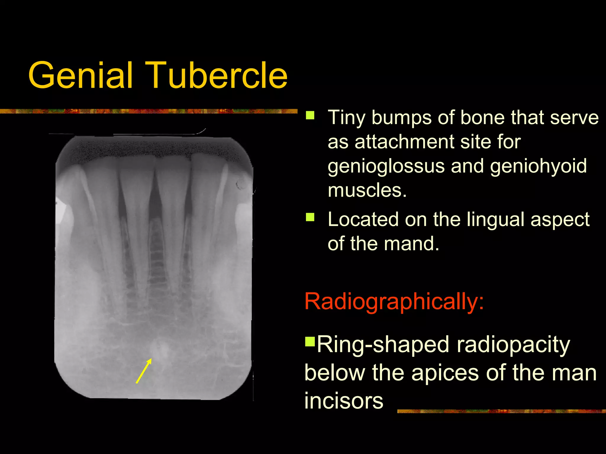 Intra Oral radiographic anatomical landmarks | PPT