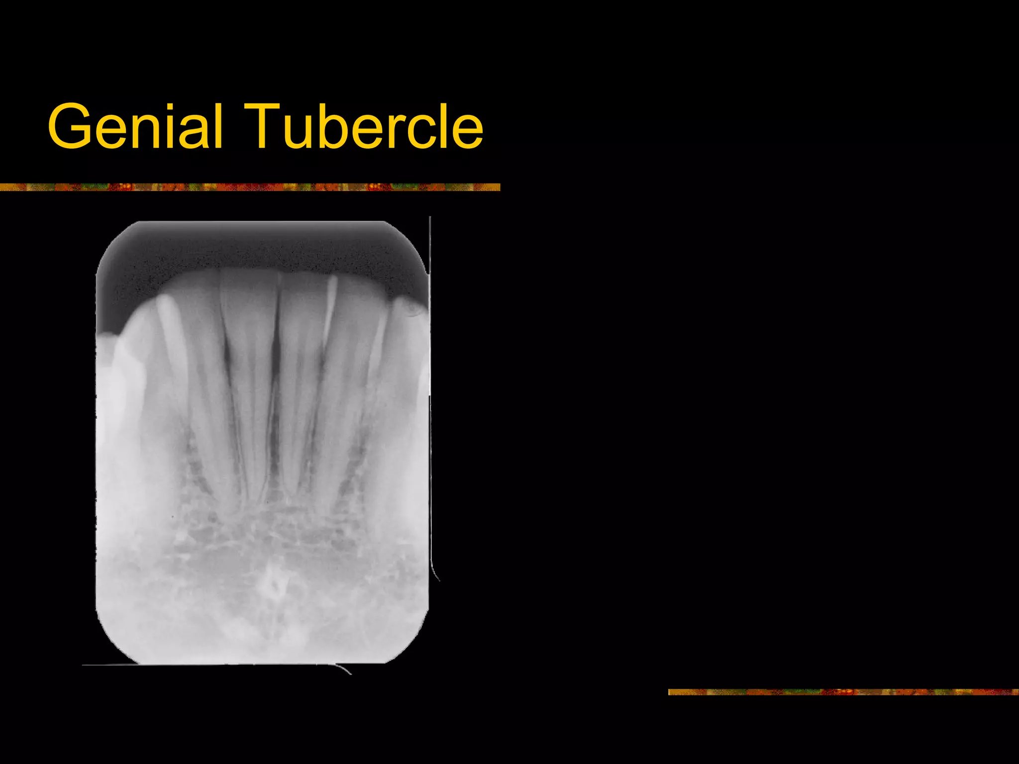 Intra Oral radiographic anatomical landmarks | PPT
