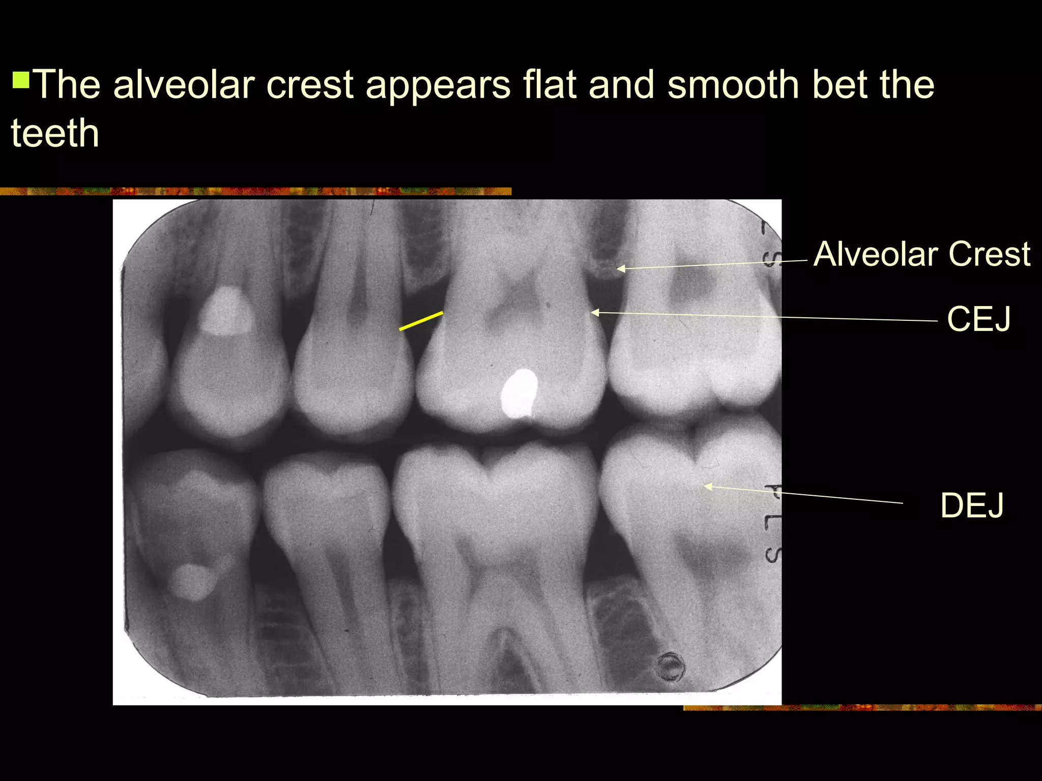 Intra Oral radiographic anatomical landmarks | PPT