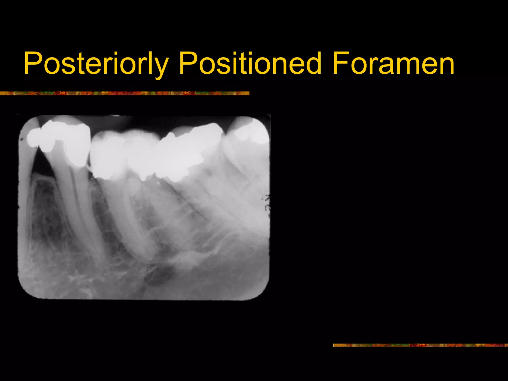 Intra Oral radiographic anatomical landmarks | PPT