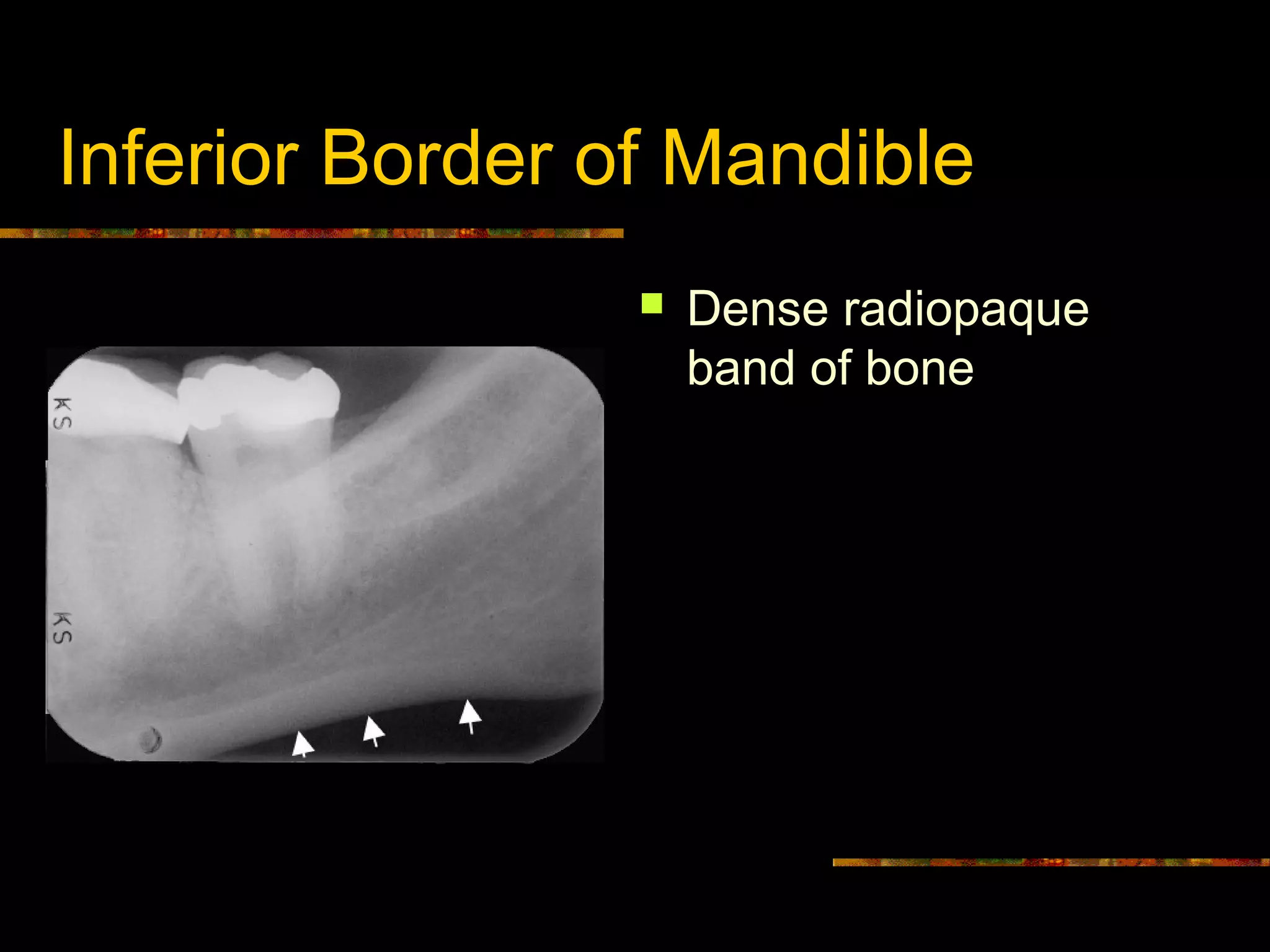 Intra Oral radiographic anatomical landmarks | PPT