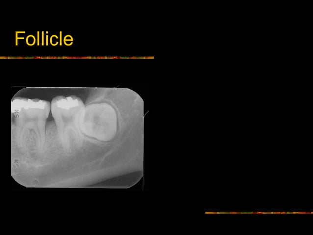Intra Oral radiographic anatomical landmarks | PPT