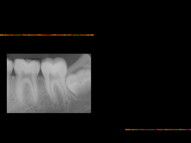 Intra Oral radiographic anatomical landmarks | PPT