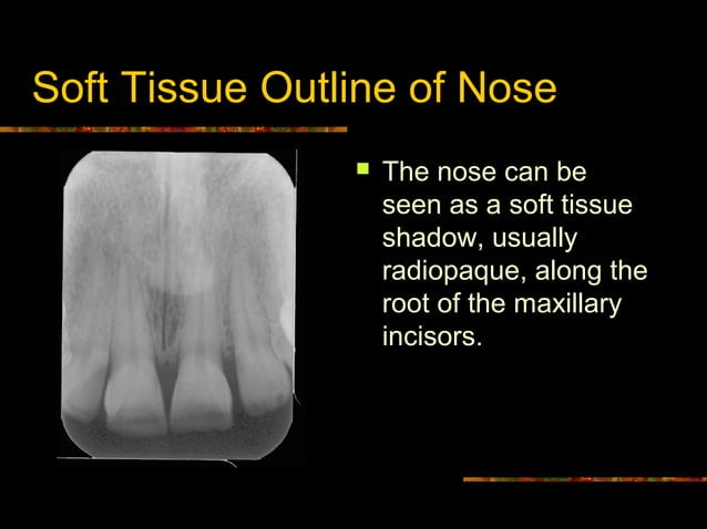 Intra Oral radiographic anatomical landmarks | PPT