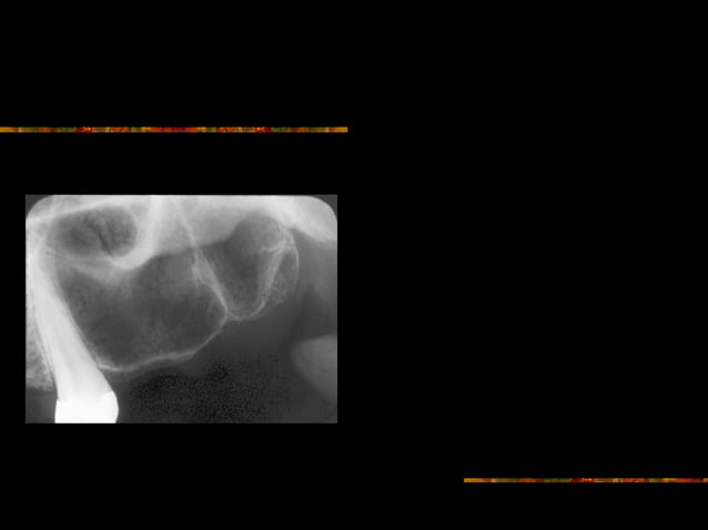 Intra Oral radiographic anatomical landmarks | PPT