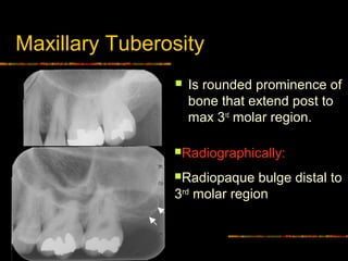 Intra Oral radiographic anatomical landmarks | PPT