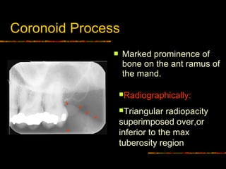 Intra Oral radiographic anatomical landmarks | PPT