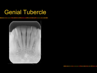 Intra Oral radiographic anatomical landmarks | PPT