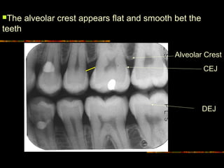 Intra Oral radiographic anatomical landmarks | PPT