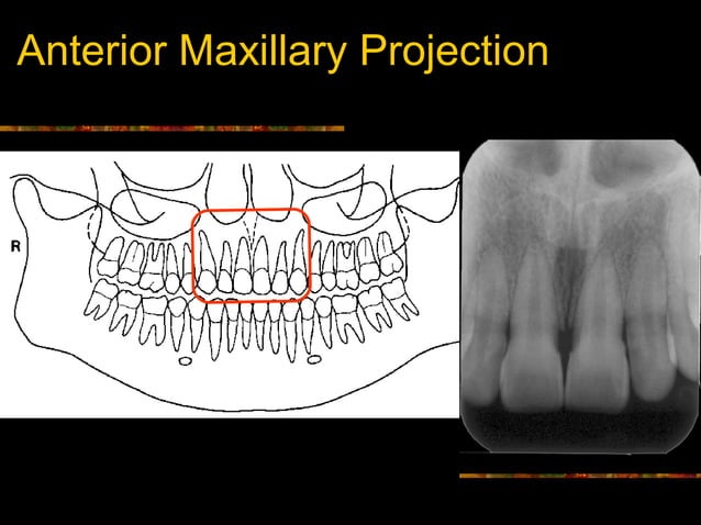 Intra Oral radiographic anatomical landmarks
