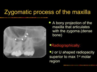 Zygomatic Process Radiograph