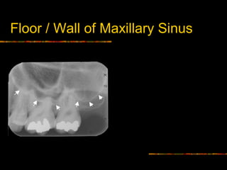Zygomatic Process Of The Maxilla Radiograph