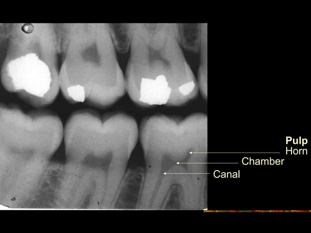 Intra Oral radiographic anatomical landmarks