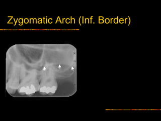 Zygomatic Arch Radiograph