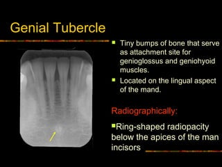 Radiographie Géniale Du Tubercule