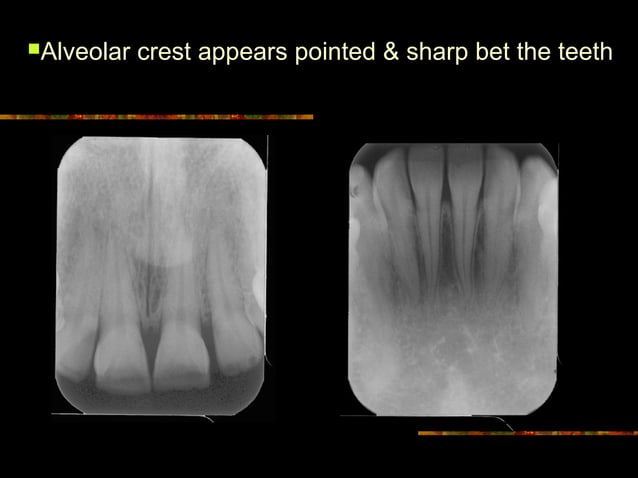 Intra Oral radiographic anatomical landmarks
