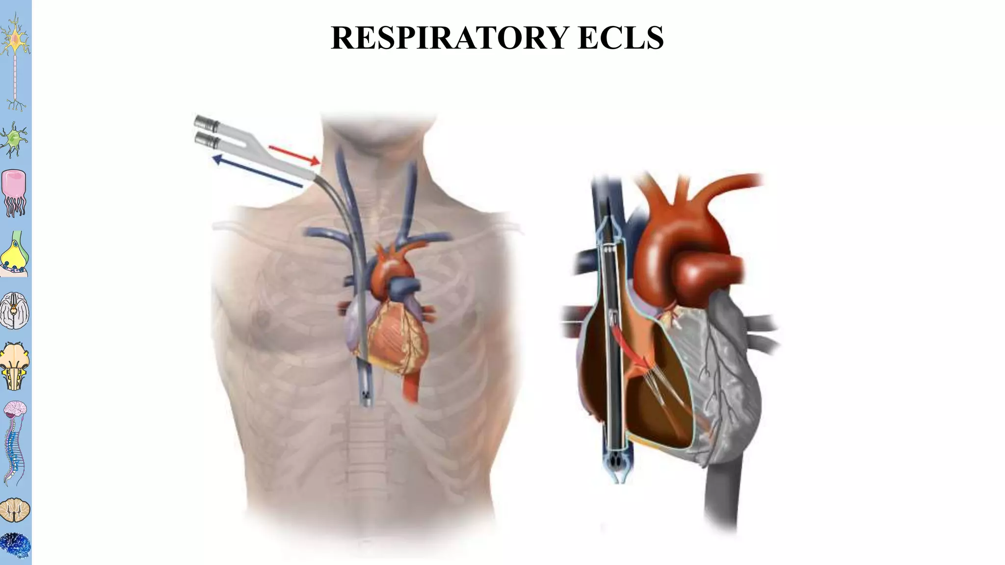3. ecmo different modes and principles va vv #beach2019 (taccone) | PPT