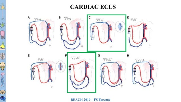 3. ecmo different modes and principles va vv #beach2019 (taccone) | PPT