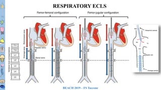 3. ecmo different modes and principles va vv #beach2019 (taccone) | PPT