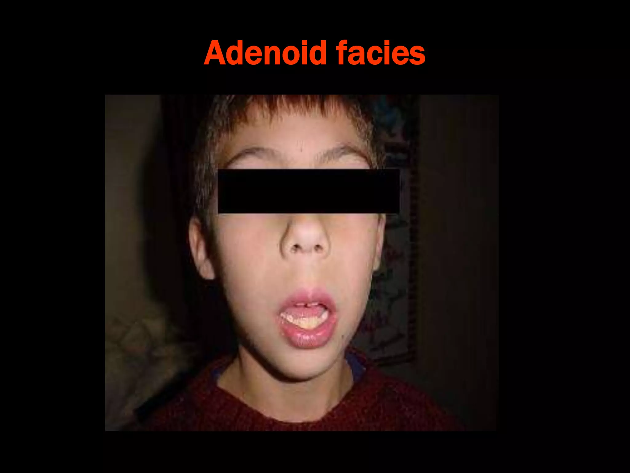 Tonsils and adenoids | PPT