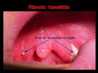 Tonsils and adenoids | PPT