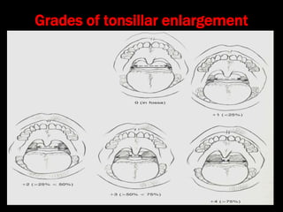 Tonsils and adenoids | PPT