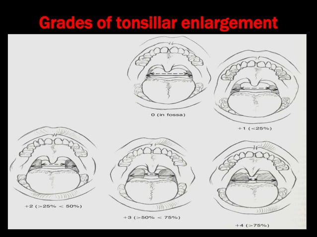Tonsils and adenoids | PPT | Ear, Nose and Throat Conditions | Diseases ...