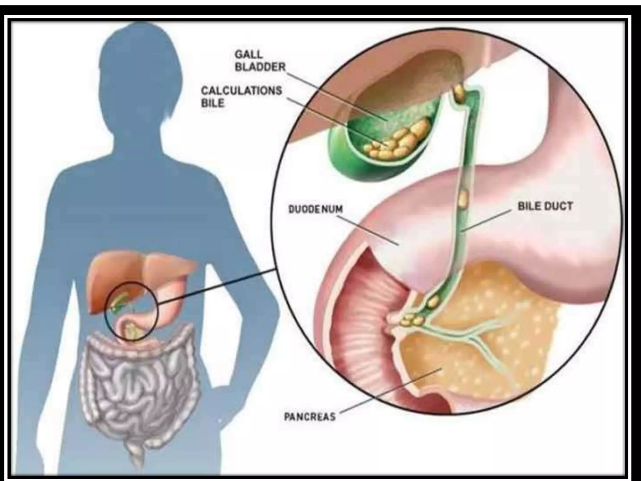 a case presentation / study on cholelithiasis | PPTX