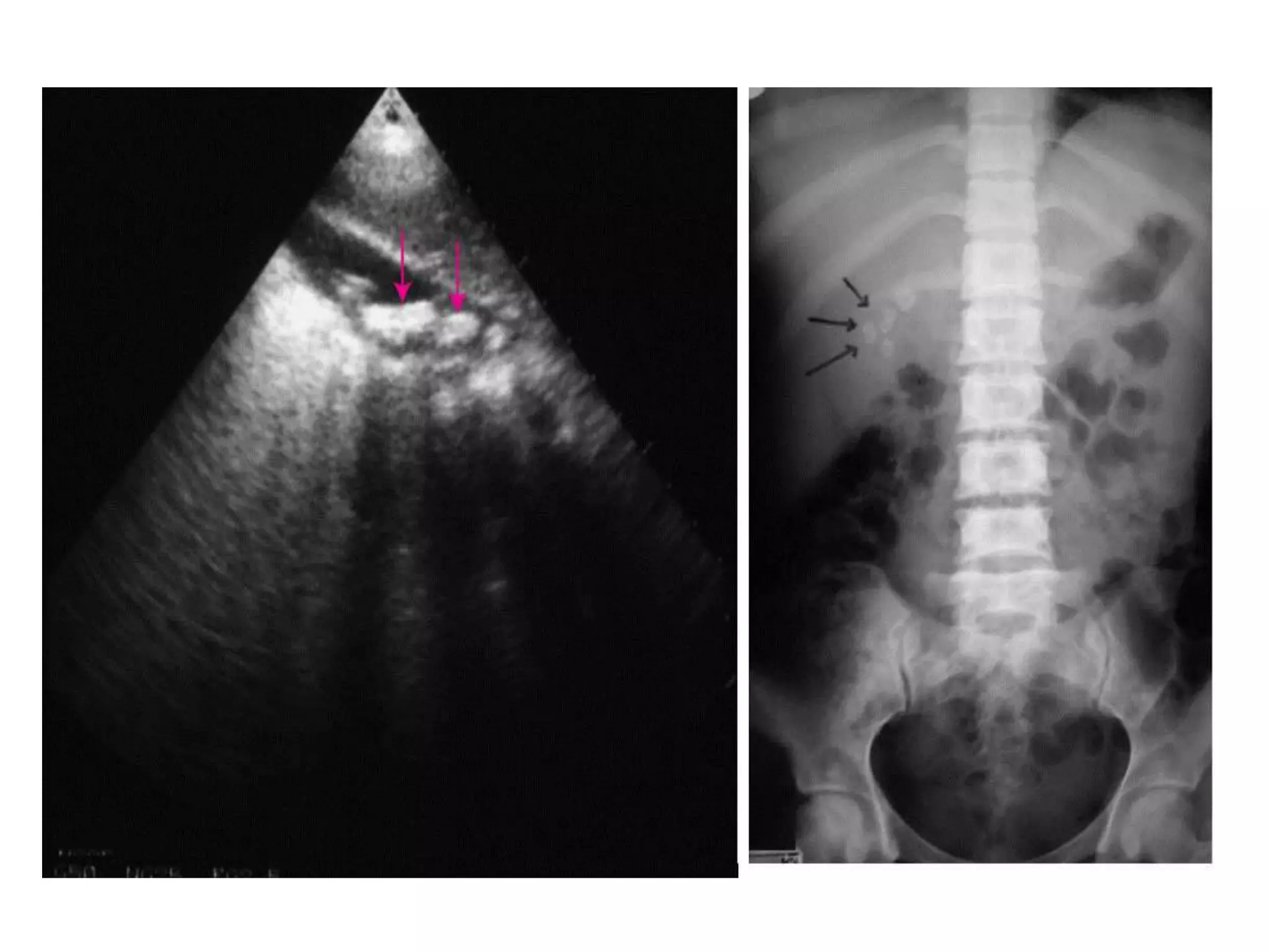 a case presentation / study on cholelithiasis | PPTX