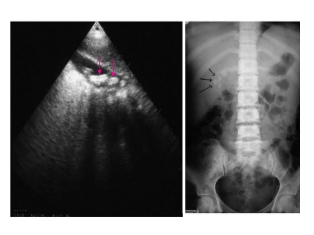 a case presentation / study on cholelithiasis | PPTX