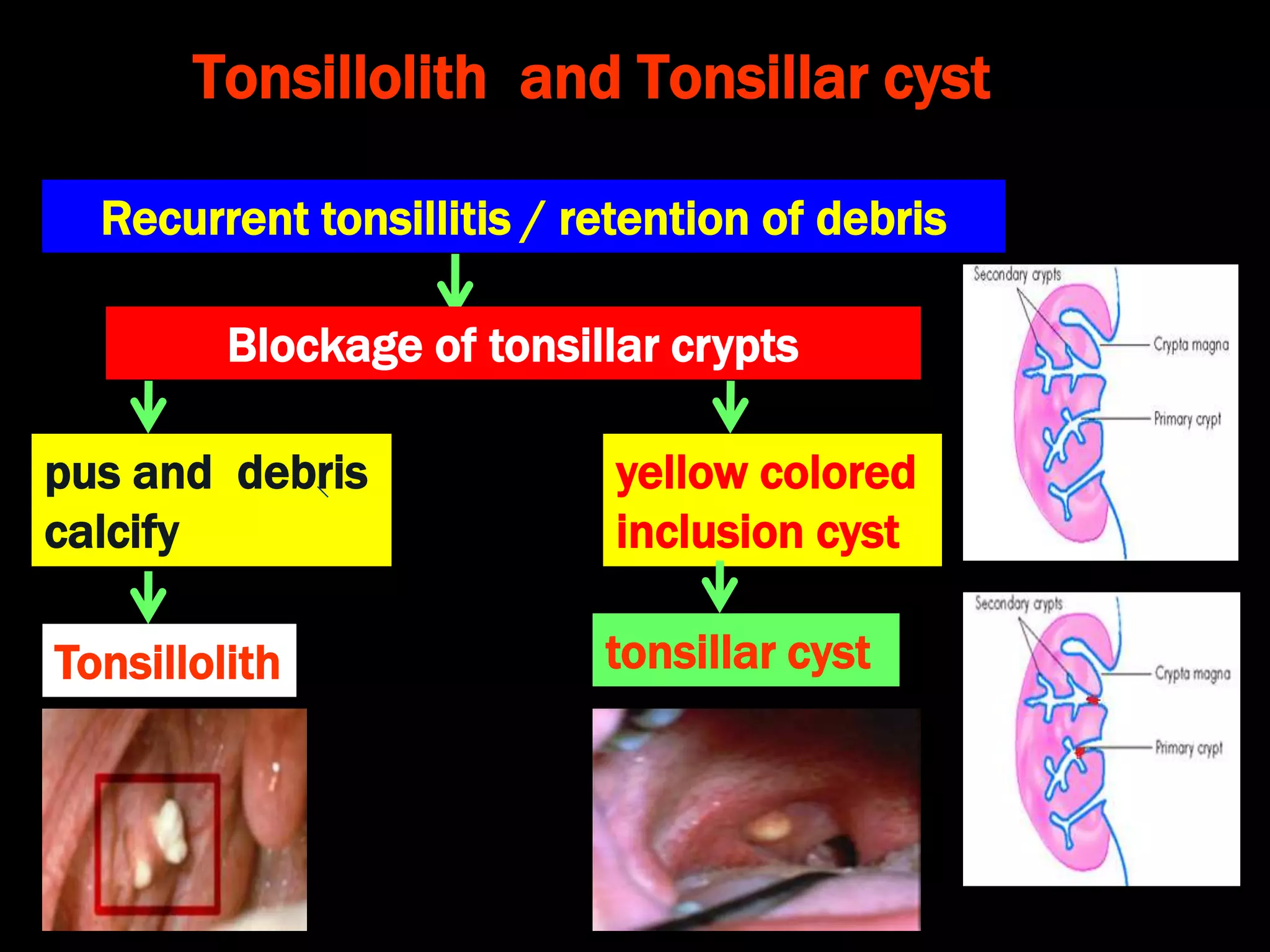 Tonsils and adenoids | PPT