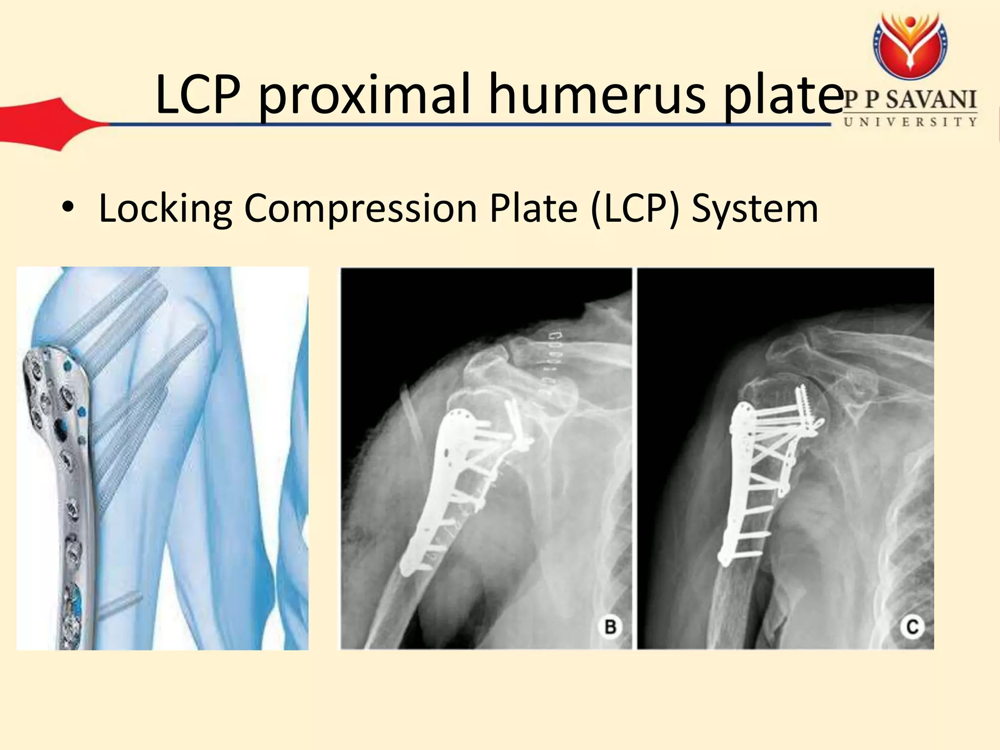 3. Fracture of Greater Tuberosity and Surgical Neck of Humerus | PPTX