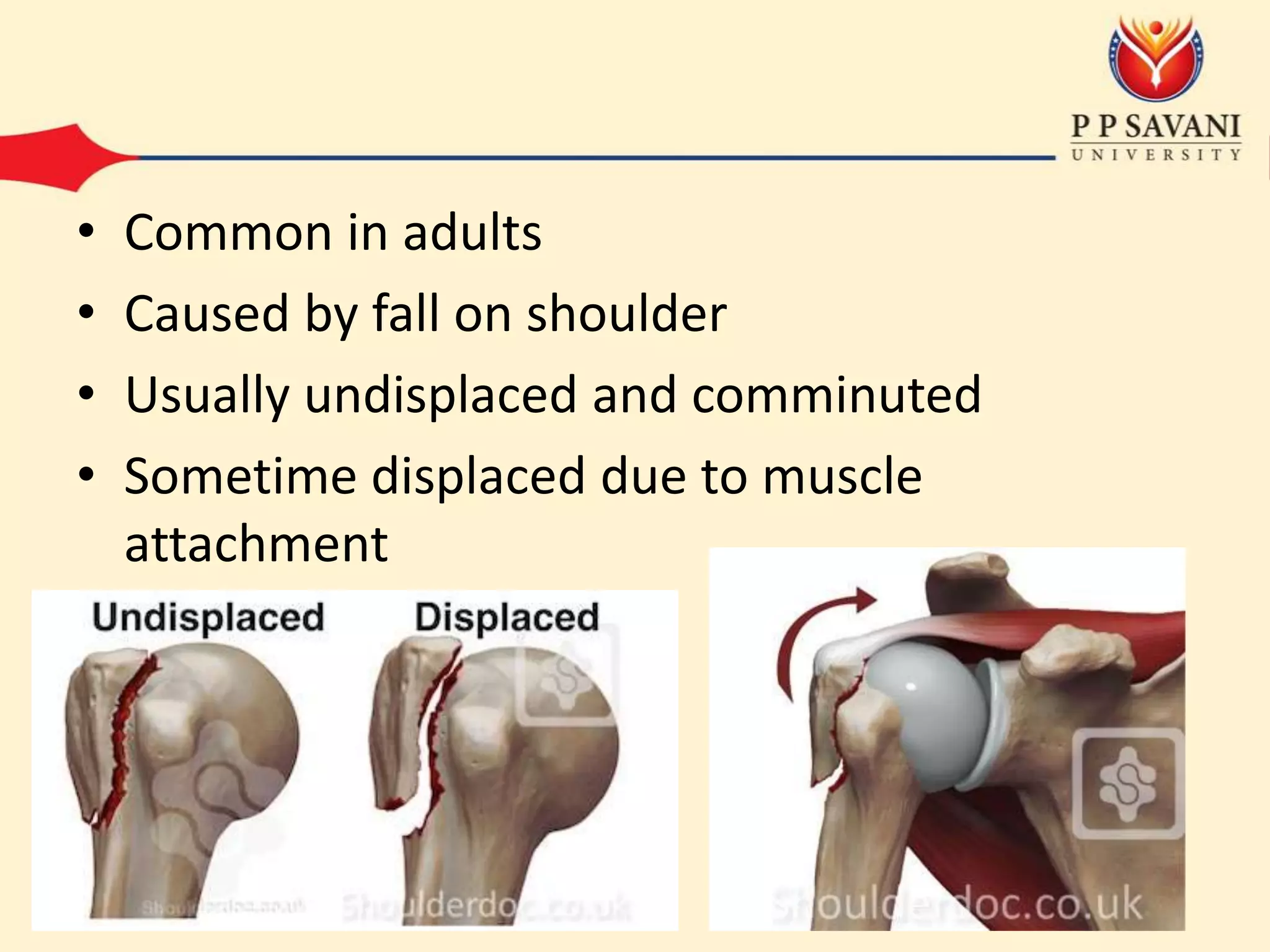 3. Fracture of Greater Tuberosity and Surgical Neck of Humerus | PPTX