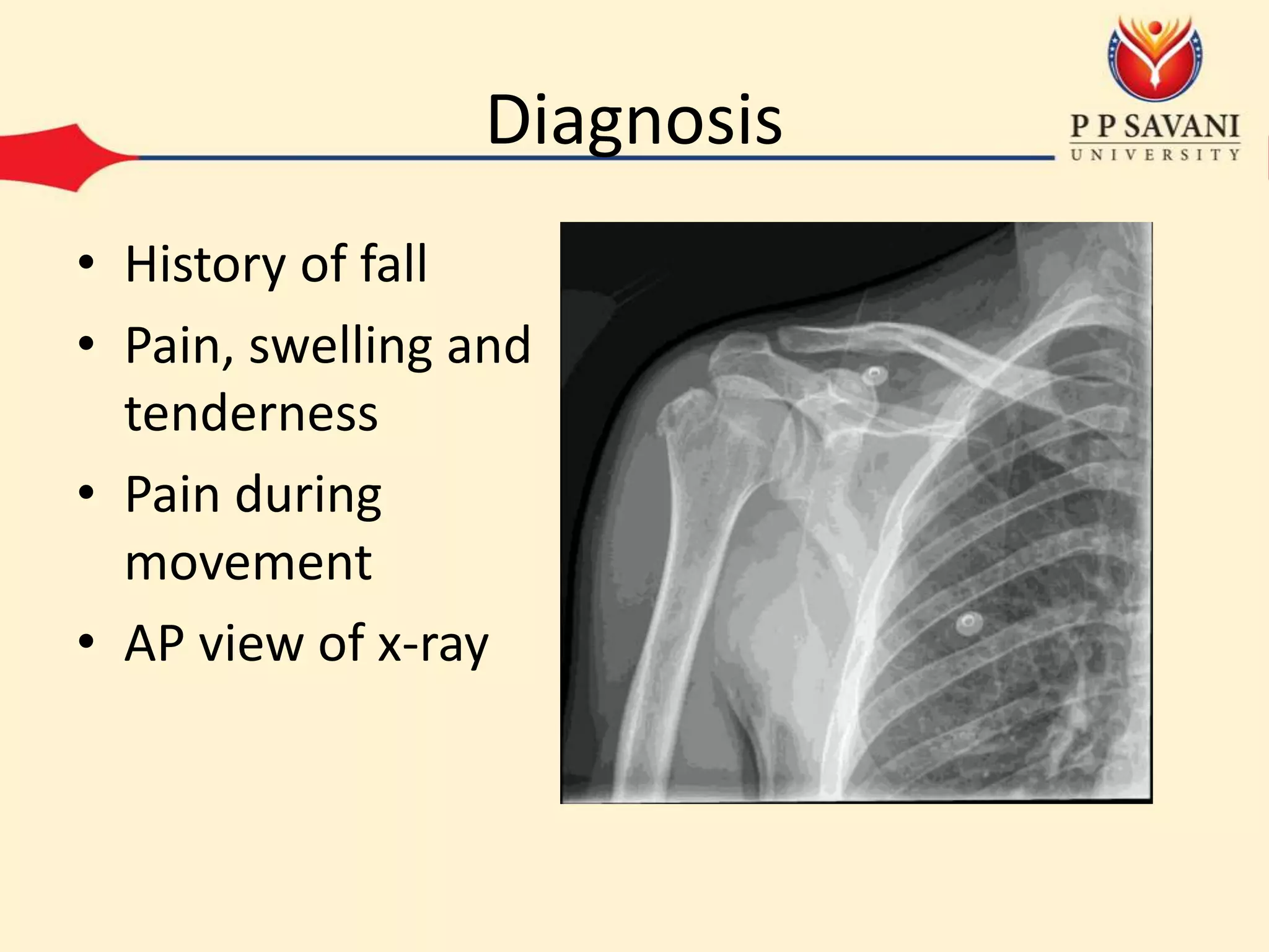 3. Fracture of Greater Tuberosity and Surgical Neck of Humerus | PPTX