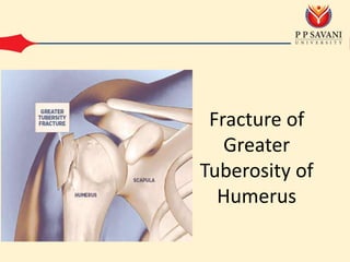 3. Fracture of Greater Tuberosity and Surgical Neck of Humerus | PPTX