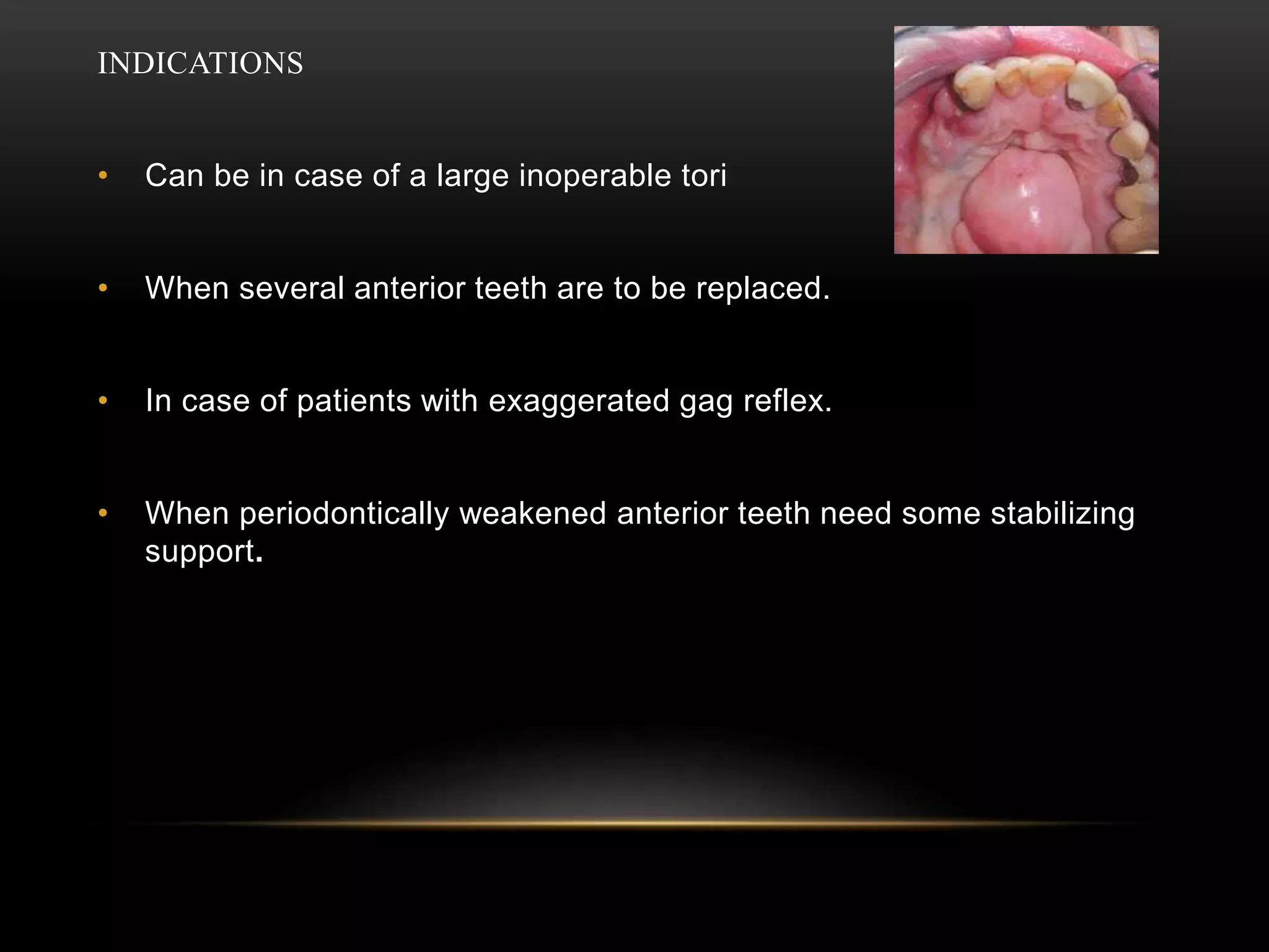 MAJOR CONNECTORS AND MINOR CONNECTORS IN RPD - Dr Prathibha Prasad | PPTX