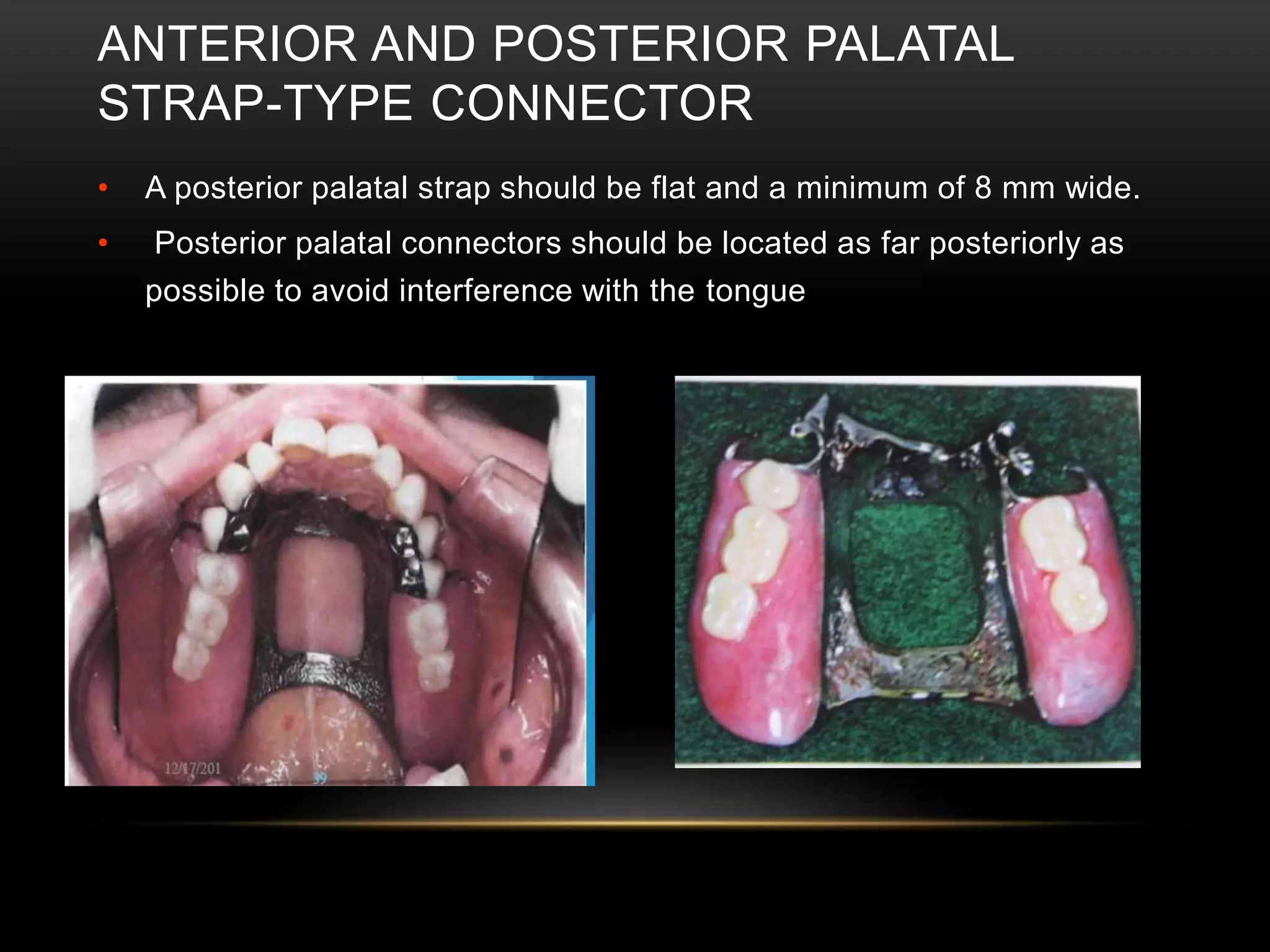 MAJOR CONNECTORS AND MINOR CONNECTORS IN RPD - Dr Prathibha Prasad ...