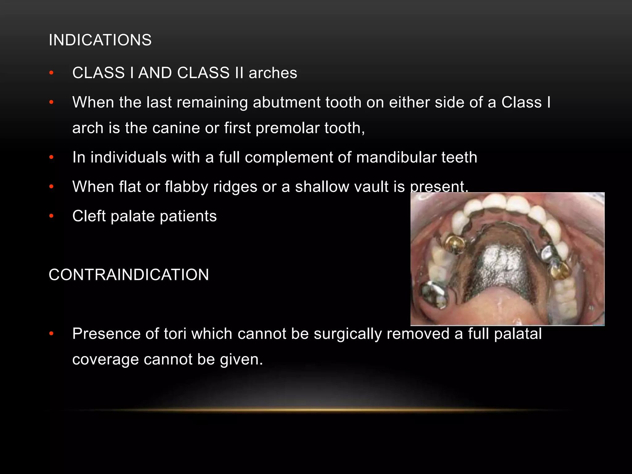 MAJOR CONNECTORS AND MINOR CONNECTORS IN RPD - Dr Prathibha Prasad | PPTX