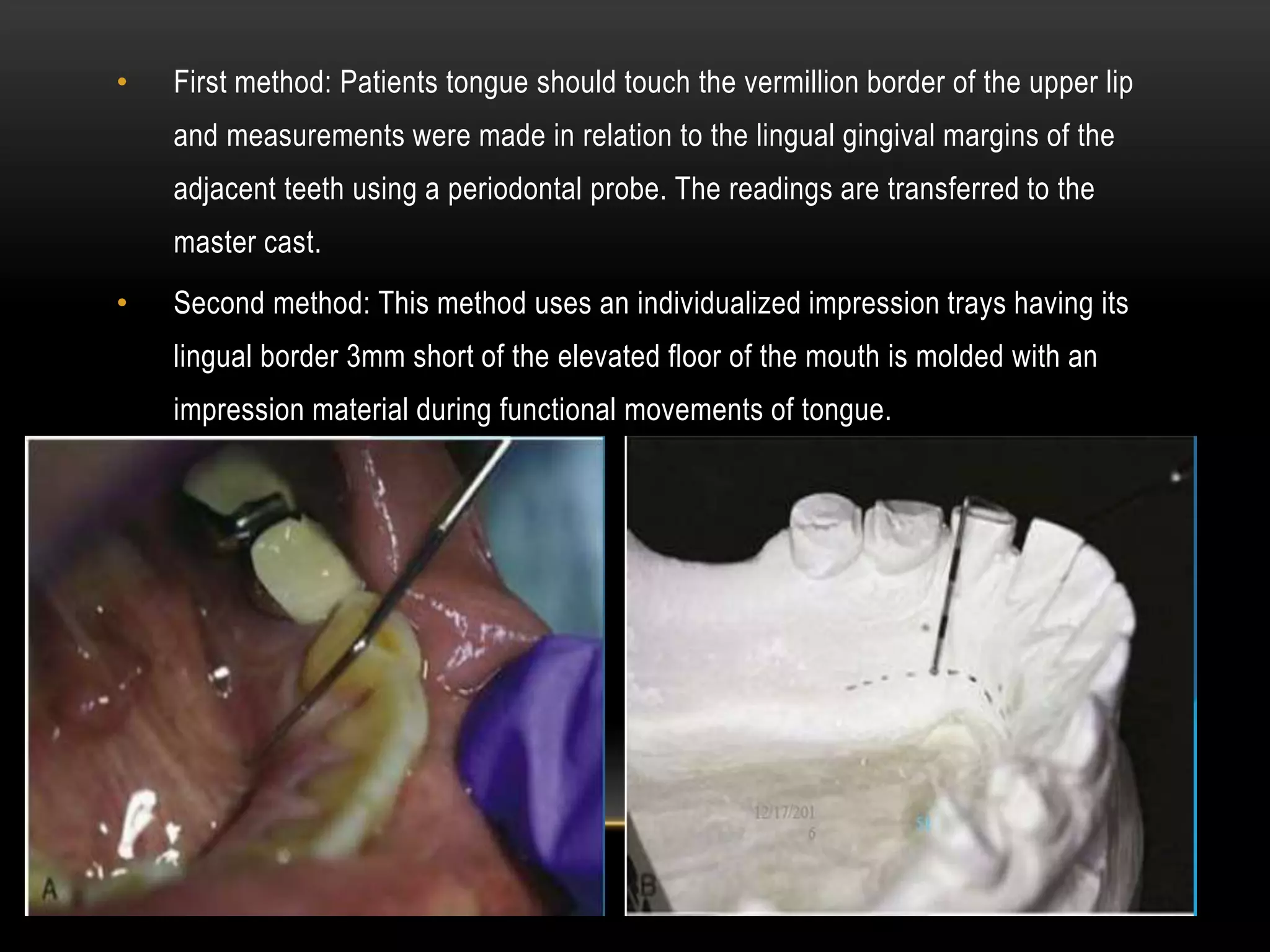 MAJOR CONNECTORS AND MINOR CONNECTORS IN RPD - Dr Prathibha Prasad | PPTX