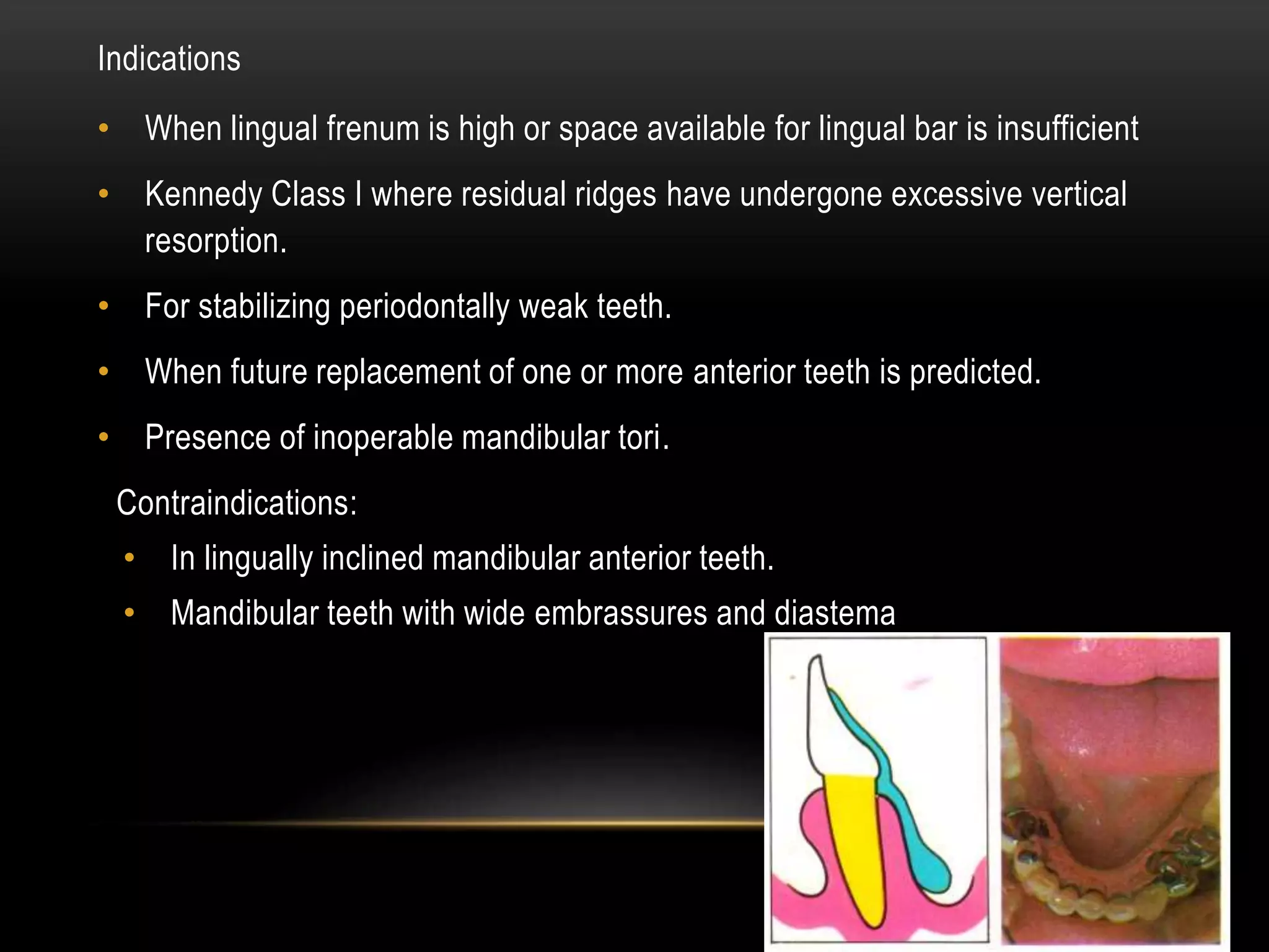 MAJOR CONNECTORS AND MINOR CONNECTORS IN RPD - Dr Prathibha Prasad | PPTX