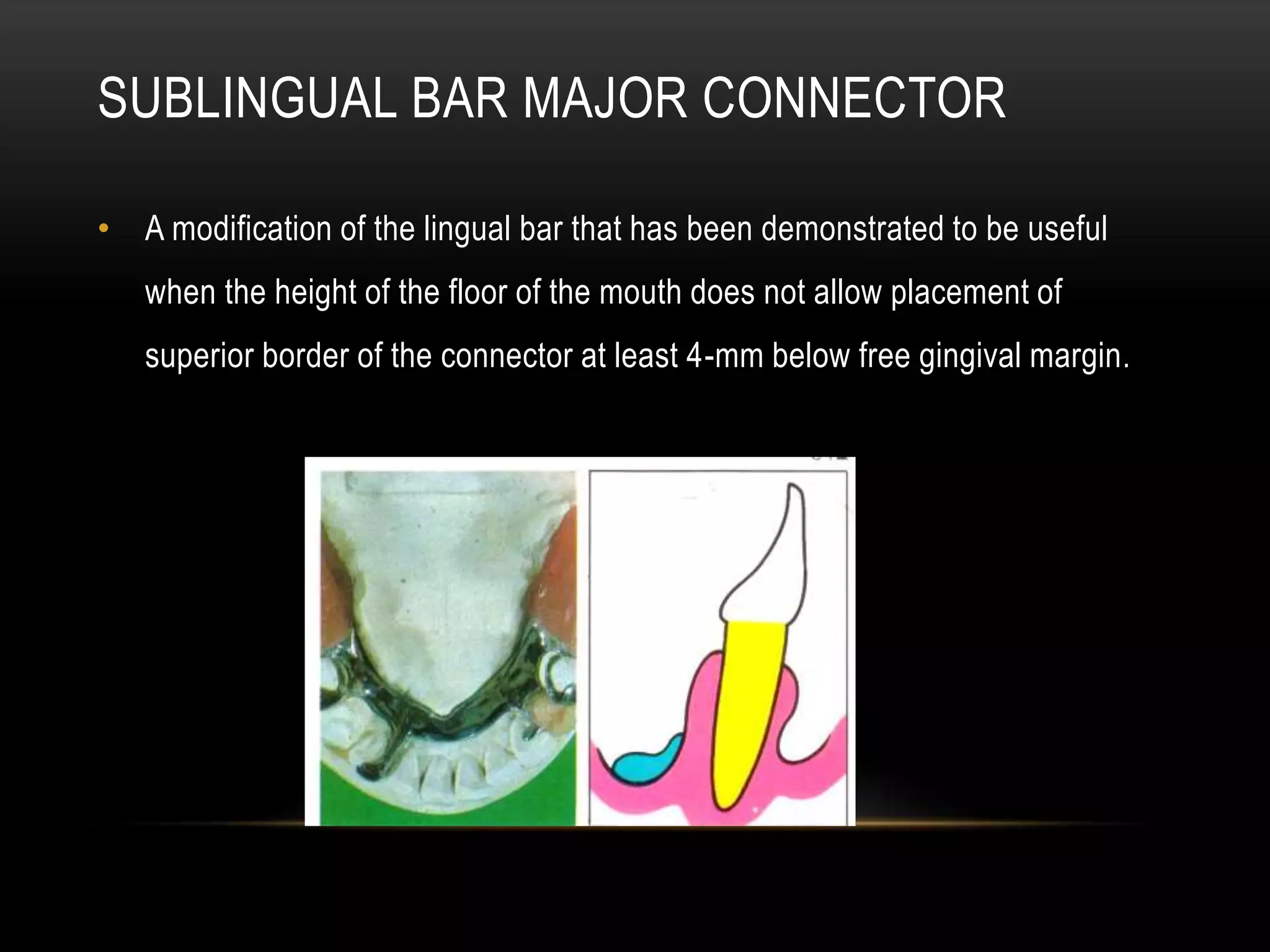MAJOR CONNECTORS AND MINOR CONNECTORS IN RPD - Dr Prathibha Prasad | PPTX