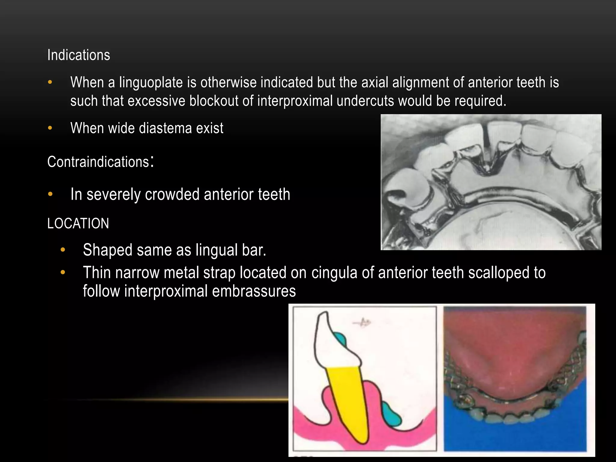 MAJOR CONNECTORS AND MINOR CONNECTORS IN RPD - Dr Prathibha Prasad ...