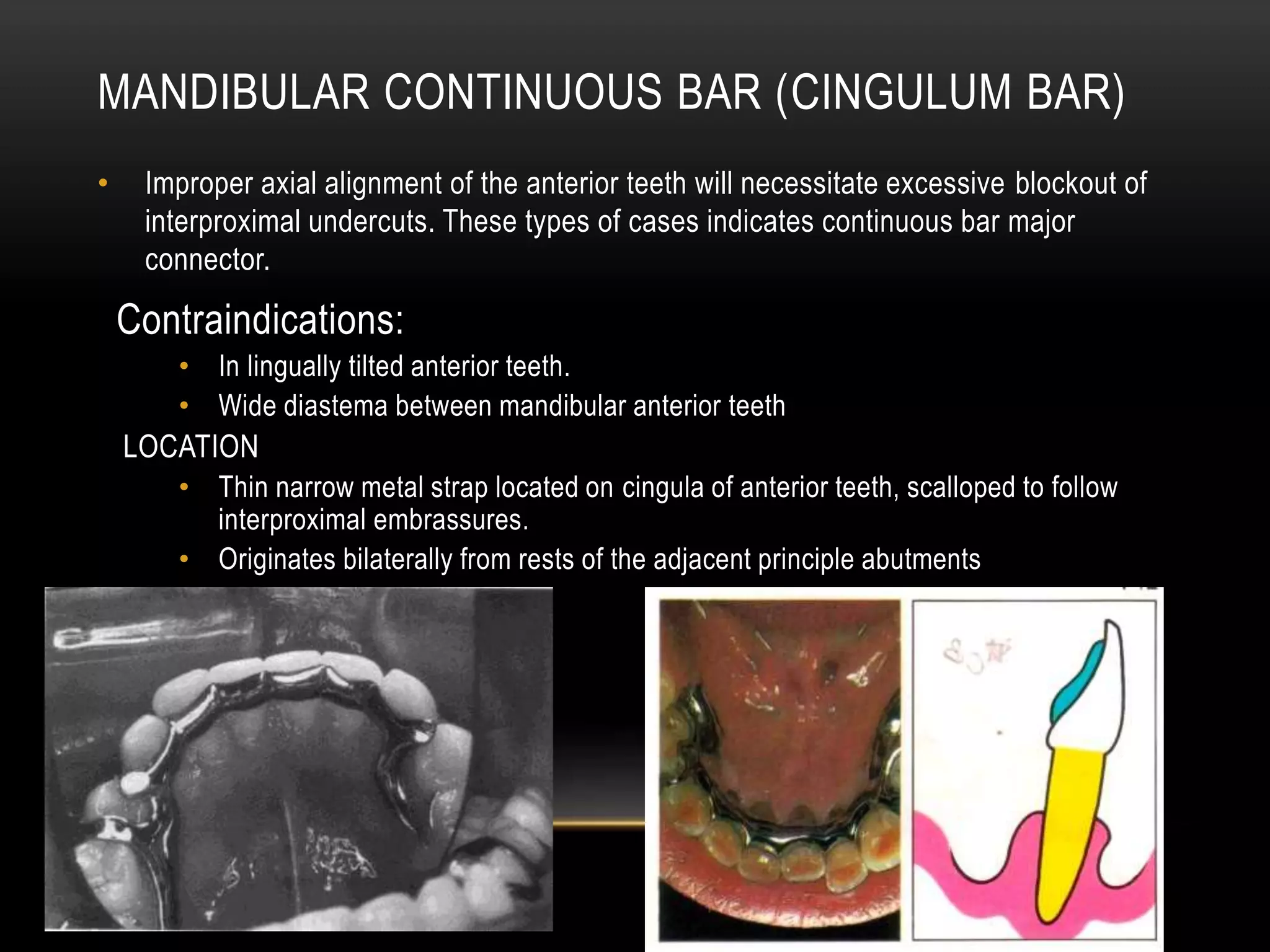 MAJOR CONNECTORS AND MINOR CONNECTORS IN RPD - Dr Prathibha Prasad | PPTX