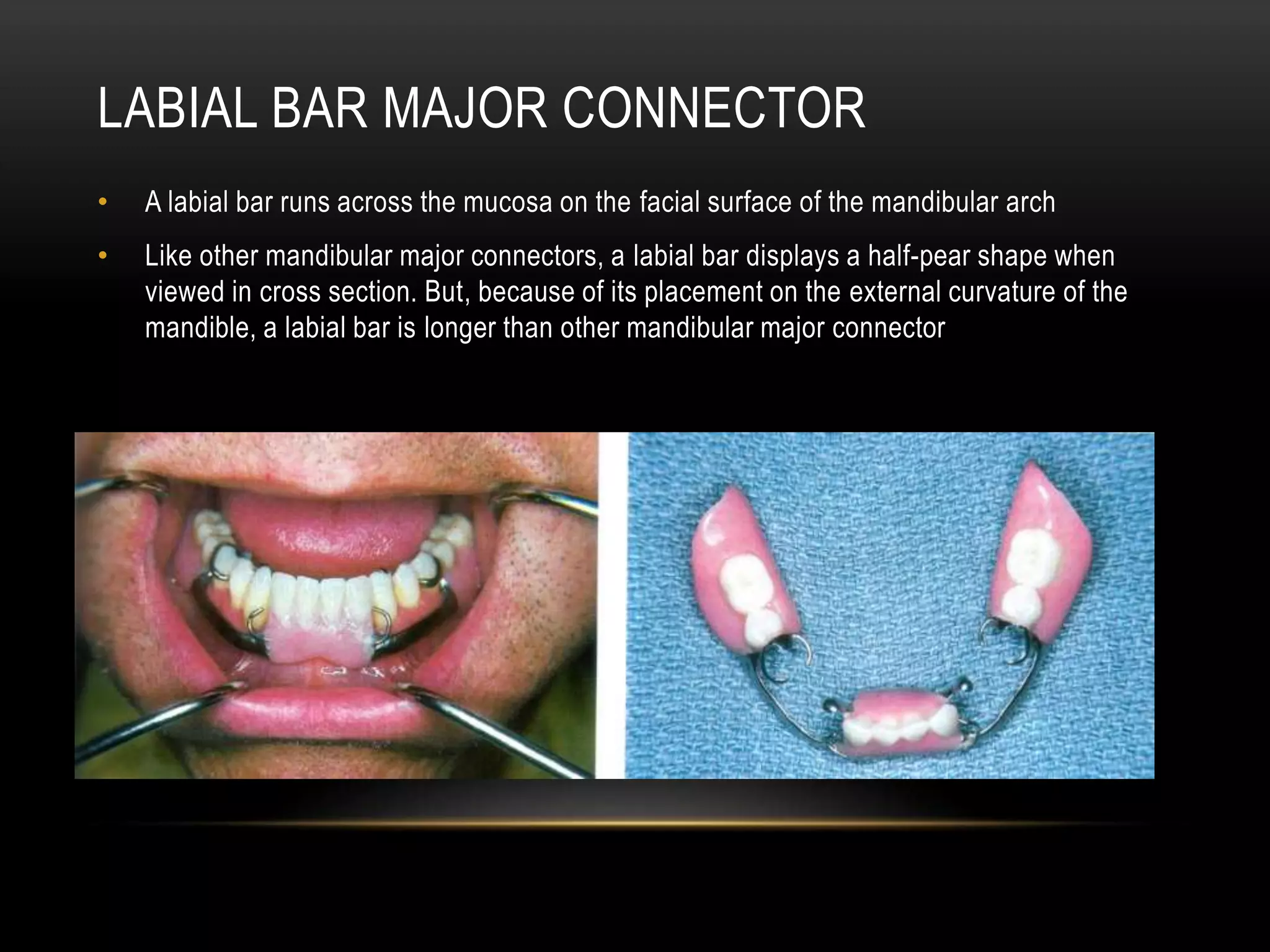 MAJOR CONNECTORS AND MINOR CONNECTORS IN RPD - Dr Prathibha Prasad ...