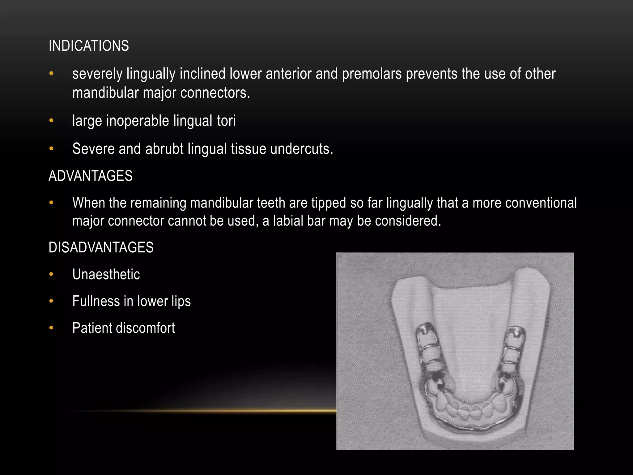 MAJOR CONNECTORS AND MINOR CONNECTORS IN RPD - Dr Prathibha Prasad | PPTX